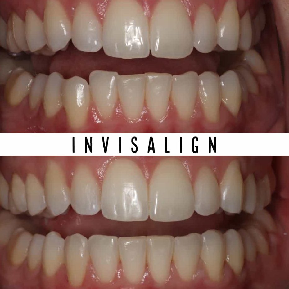 Invisalign Melbourne - Leading Invisalign Dentist Melbourne